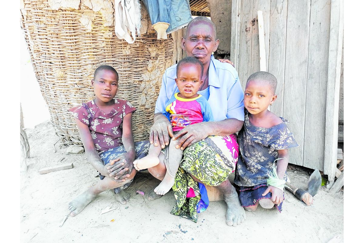 Maisha mapya ya aliyechomwa moto mikono na mama yake | Mwananchi